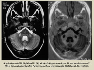 Presentation1, radiological imaging of wilson disease. | PPTX