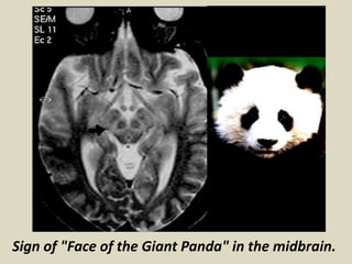 Presentation1, radiological imaging of wilson disease. | PPTX