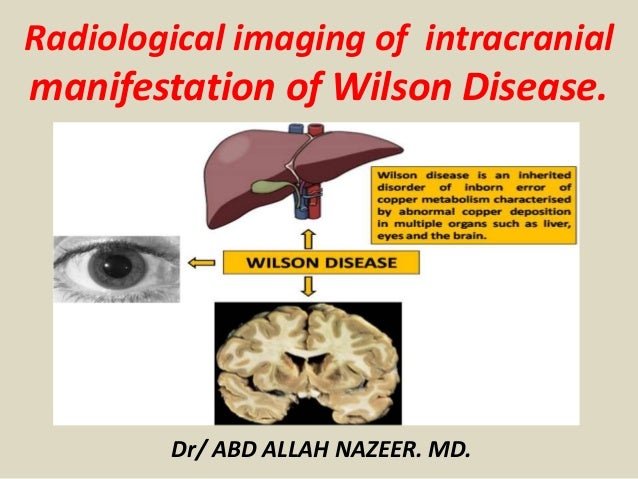 Presentation1, radiological imaging of wilson disease.