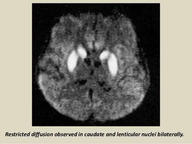 Presentation1, radiological imaging of wilson disease.