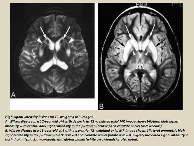 Presentation1, radiological imaging of wilson disease.