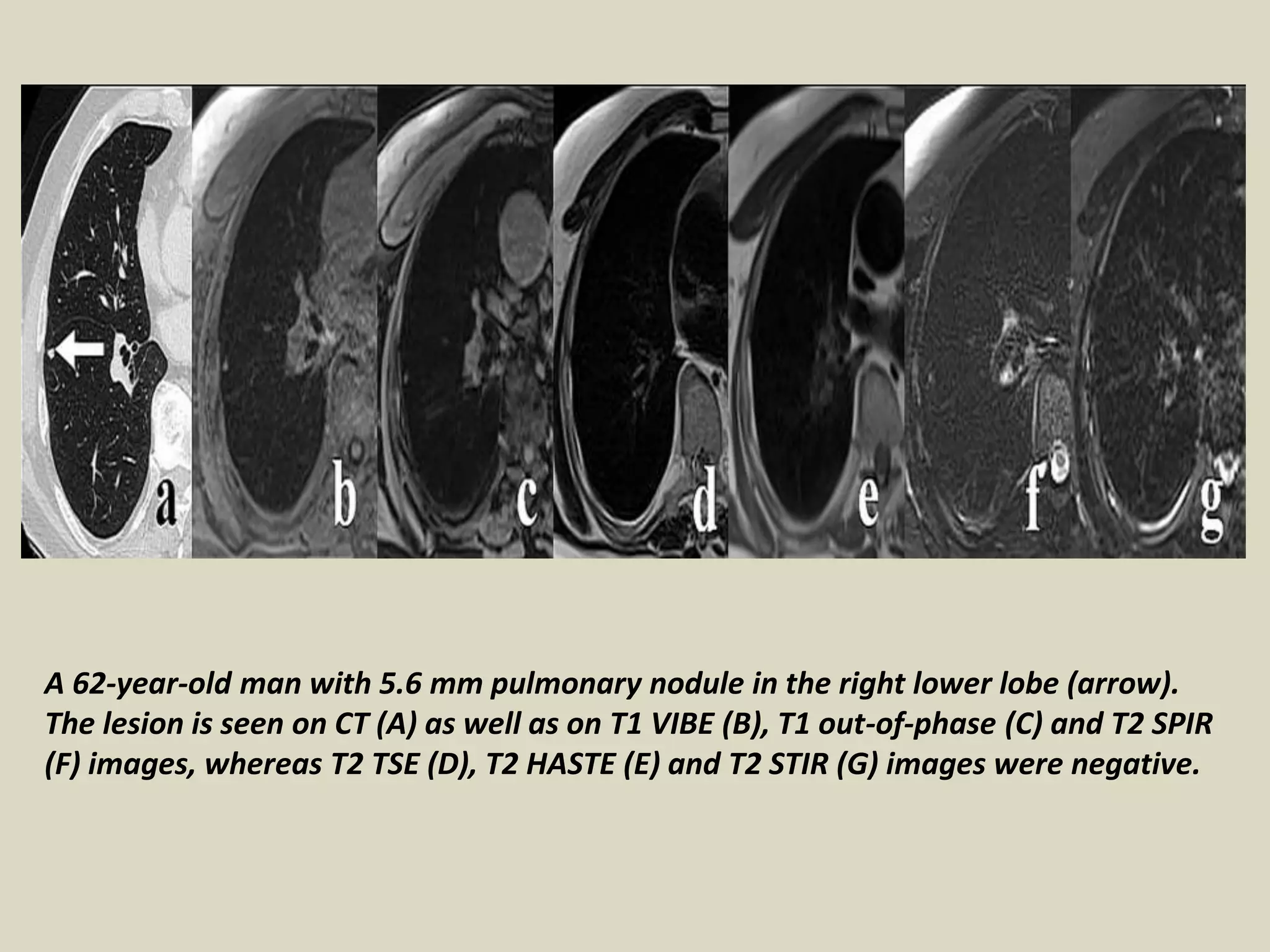 Presentation1, role of mri imaging in pulmonary nodules. | PPTX