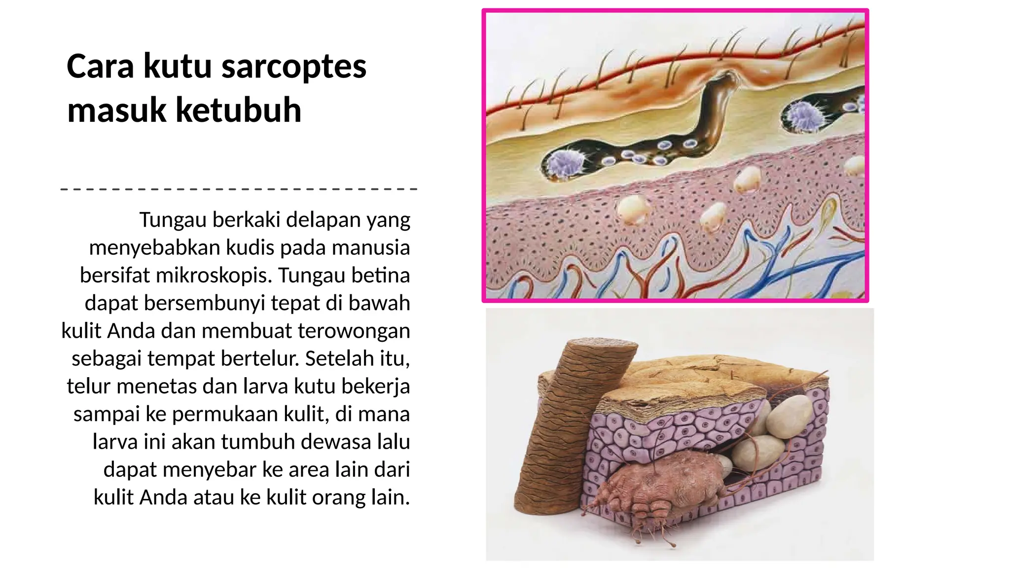 Presentation1 scabies .pptx