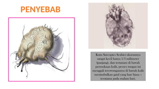 Presentation1 scabies .pptx