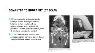 Presentation1 sialolithiasis presentation | PPTX