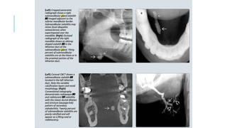 Presentation1 sialolithiasis presentation | PPTX