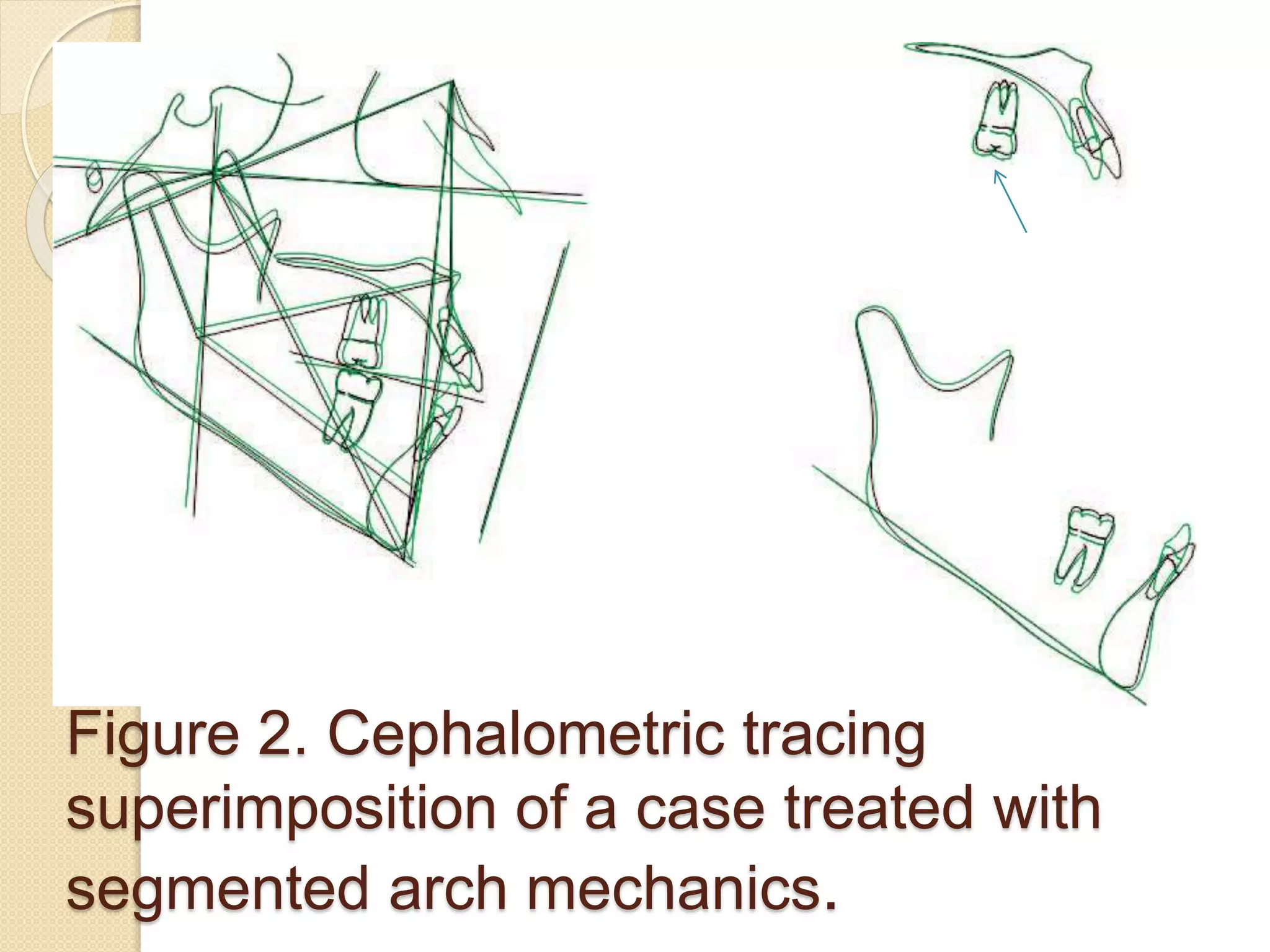 Anchorage condition during canine retraction using transpalatal arch ...