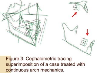 Anchorage condition during canine retraction using transpalatal arch ...