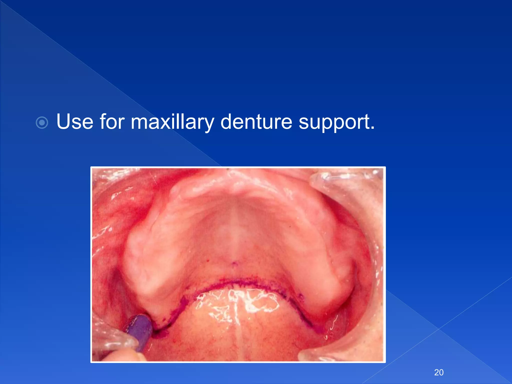 Presentation1 support for complete denture | PPTX