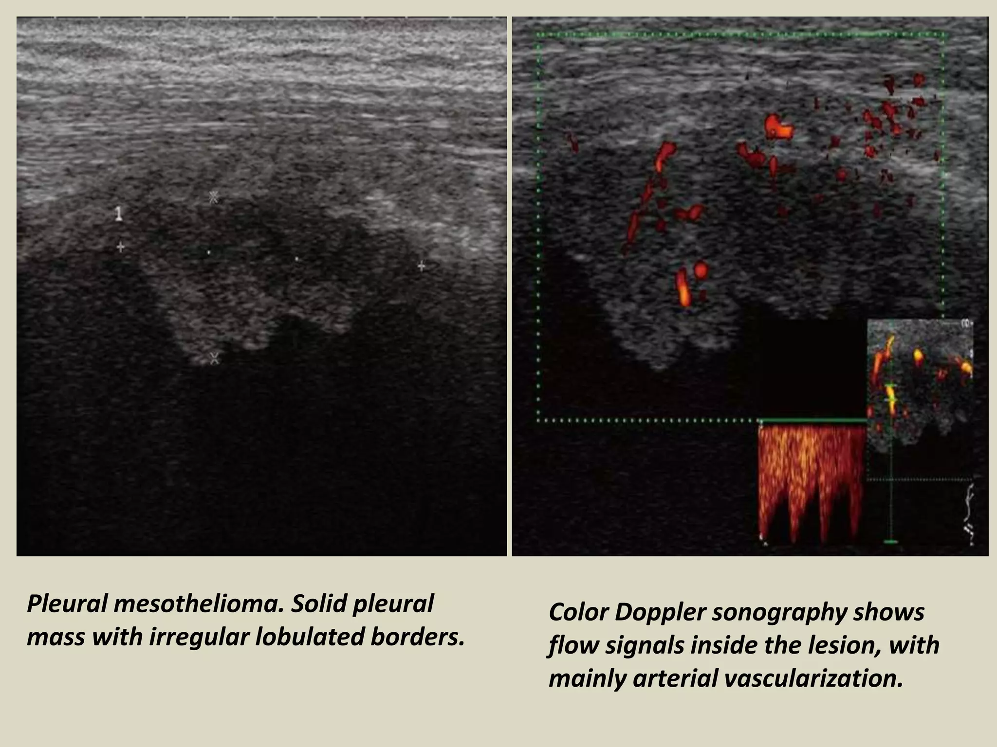 Presentation1, ultrasound examination of the chest. | PPTX