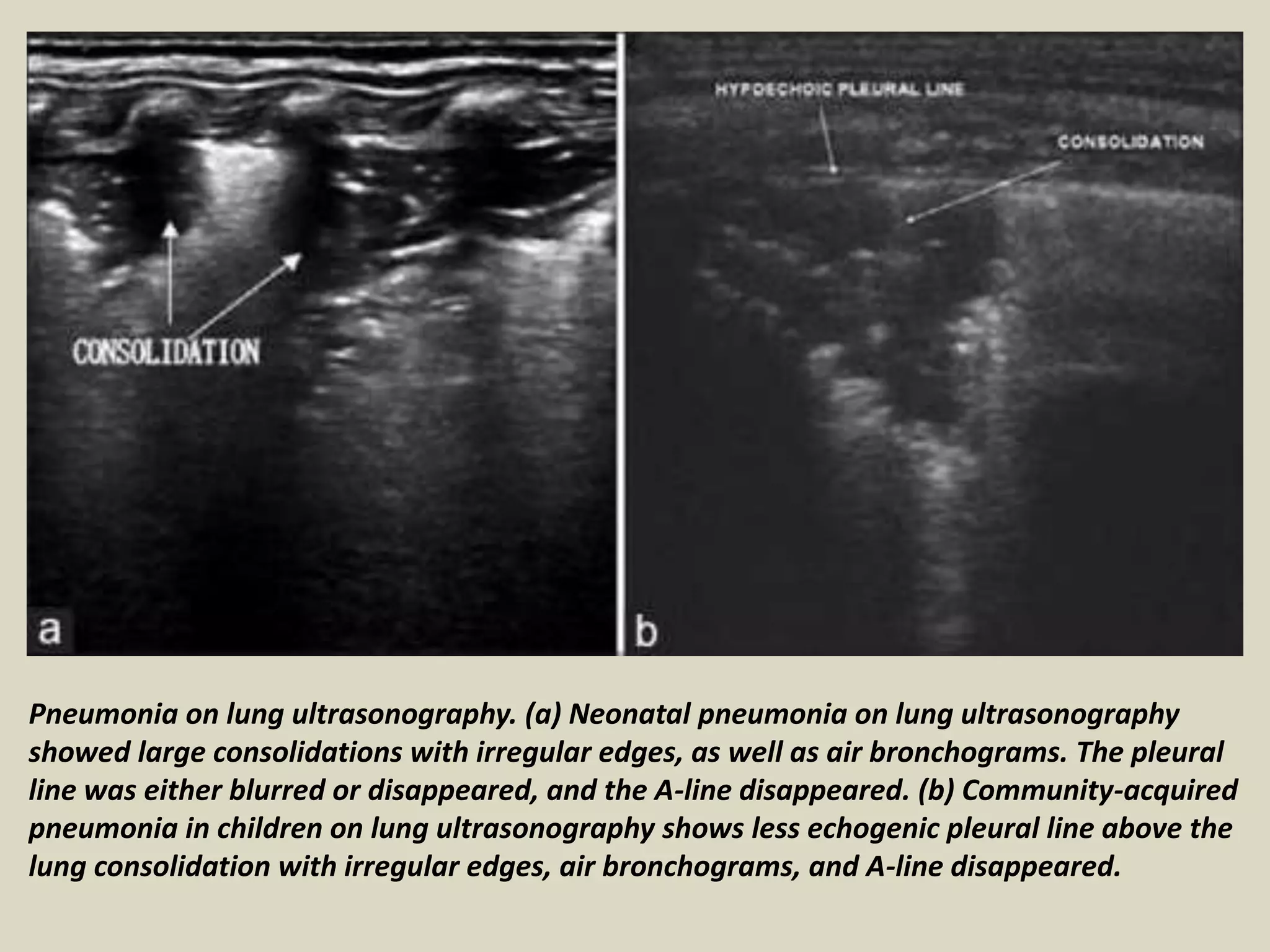 Presentation1, ultrasound examination of the chest. | PPTX