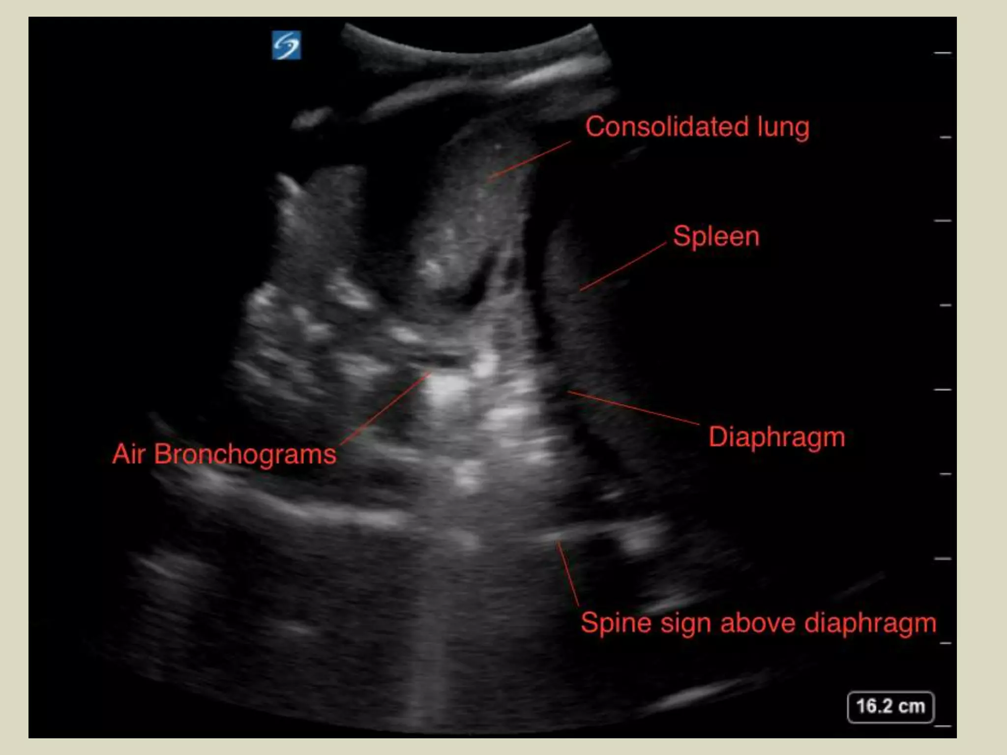 Presentation1, ultrasound examination of the chest. | PPTX
