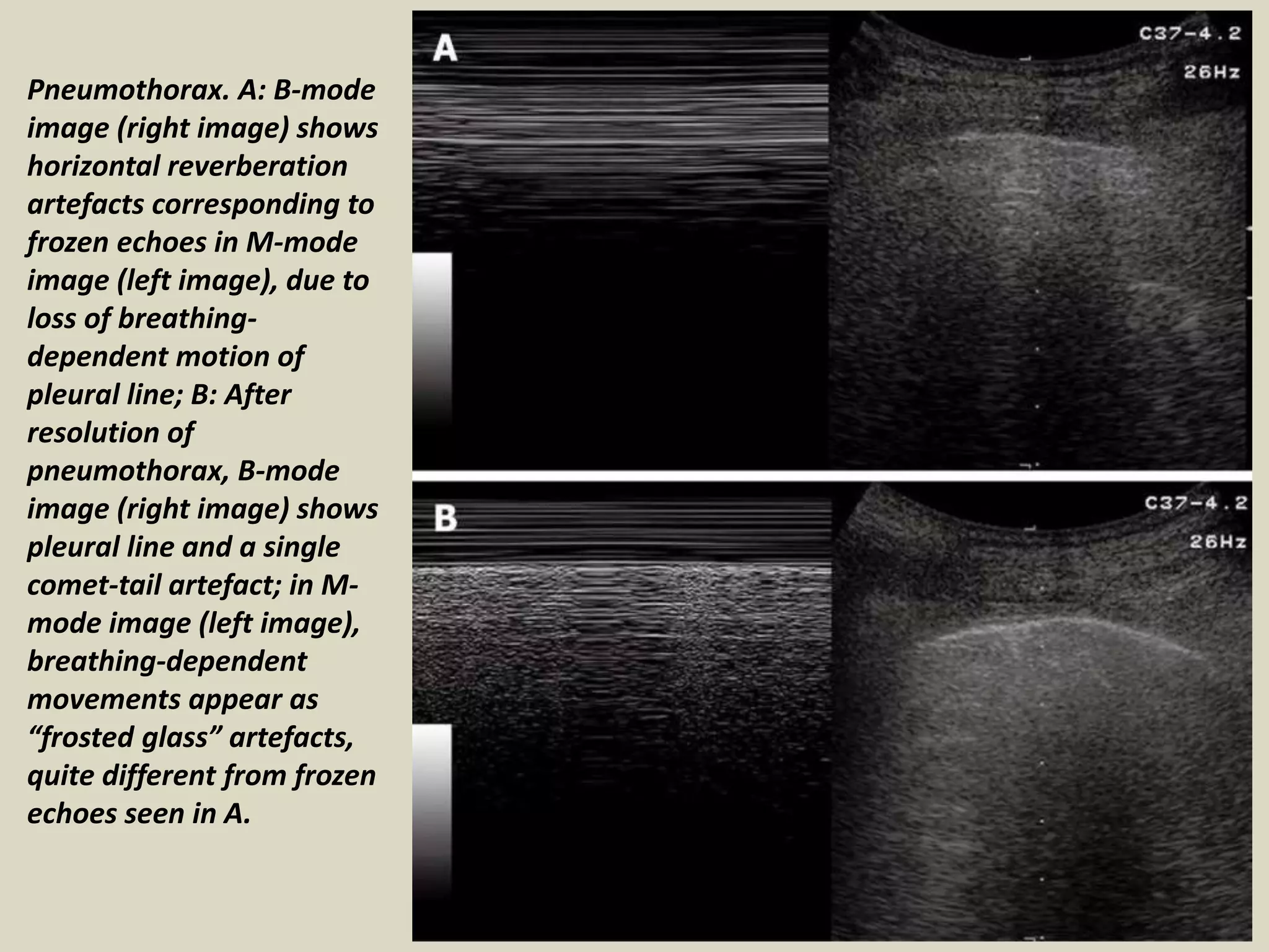 Presentation1, ultrasound examination of the chest. | PPTX