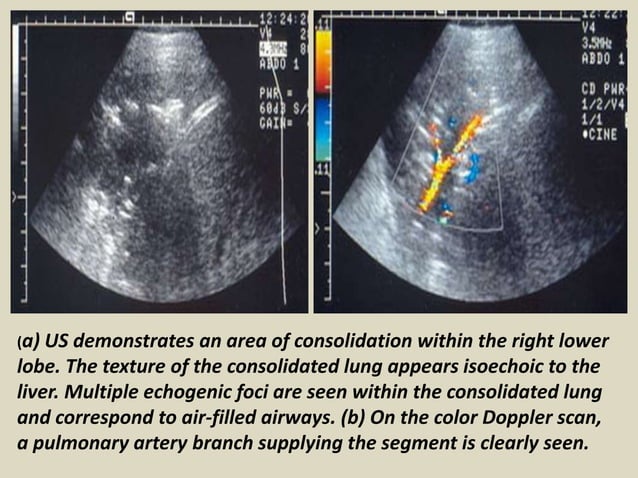 Presentation1, ultrasound examination of the chest. | PPTX | Lung and ...