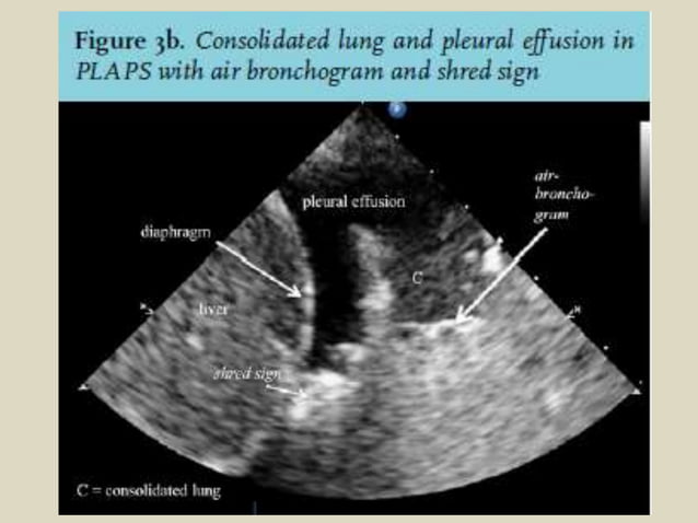 Presentation1, ultrasound examination of the chest. | PPTX | Lung and ...