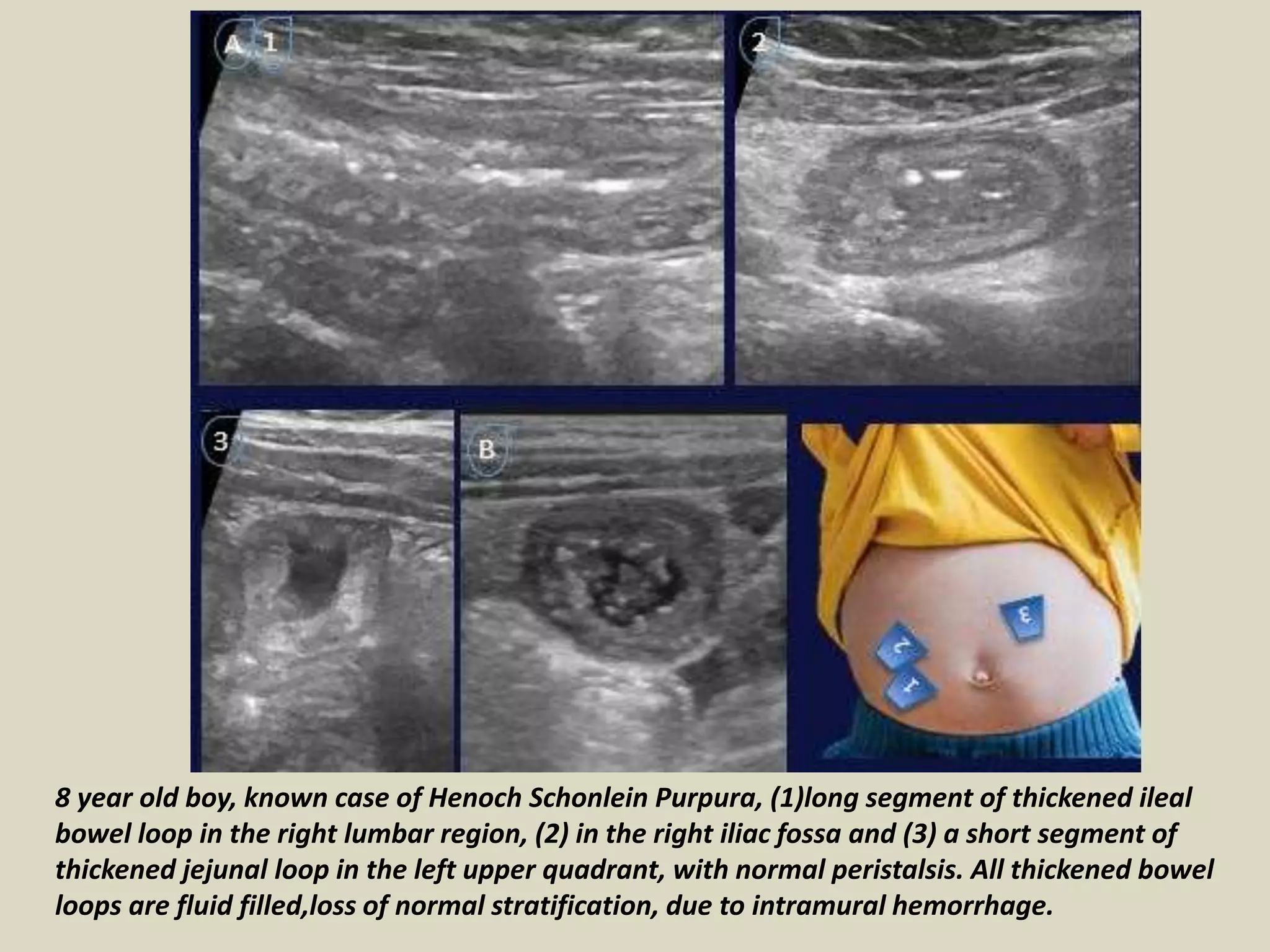 Presentation1, ultrasound of the bowel loops and the lymph nodes. | PPTX