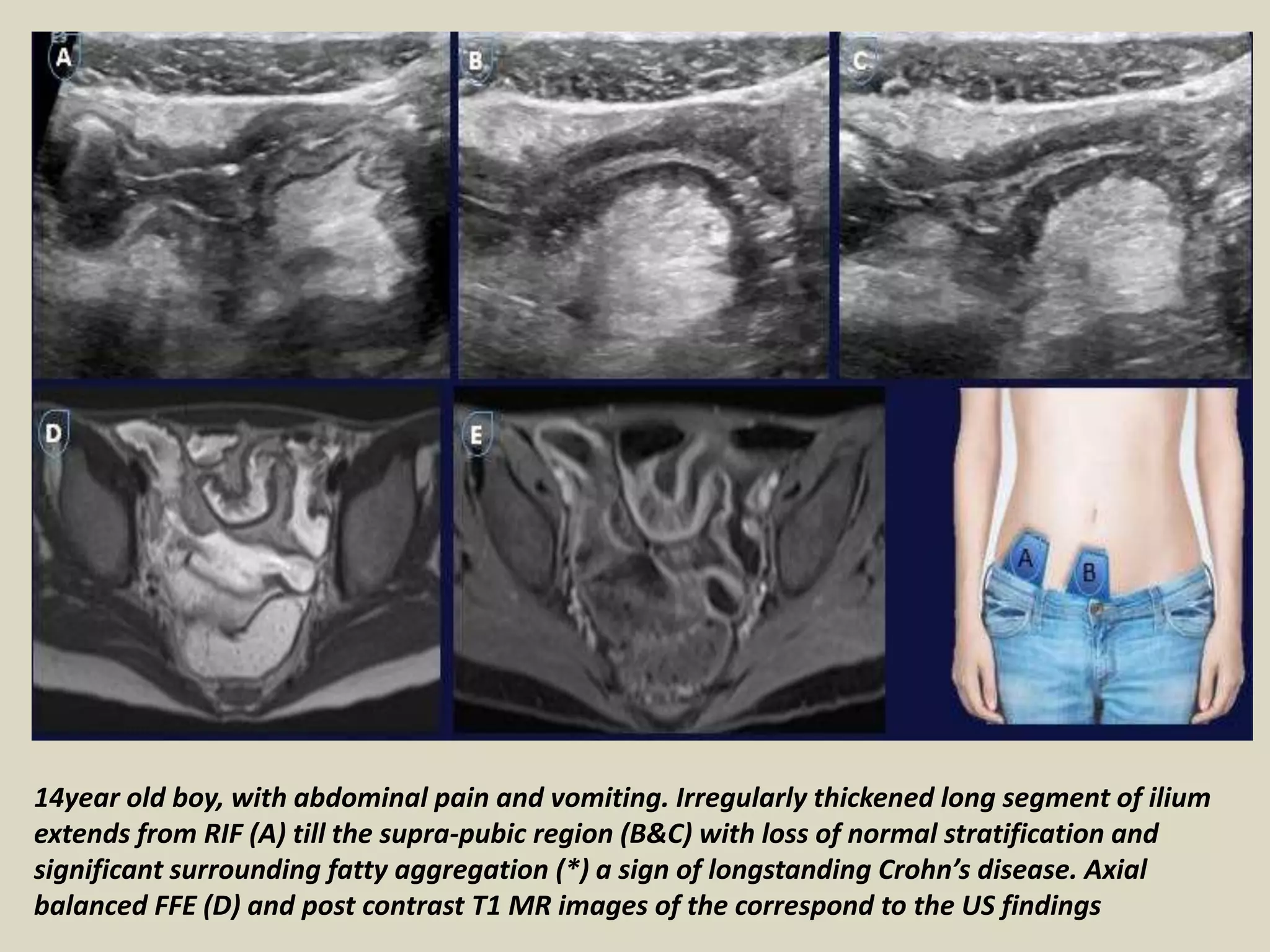 Presentation1, ultrasound of the bowel loops and the lymph nodes. | PPTX