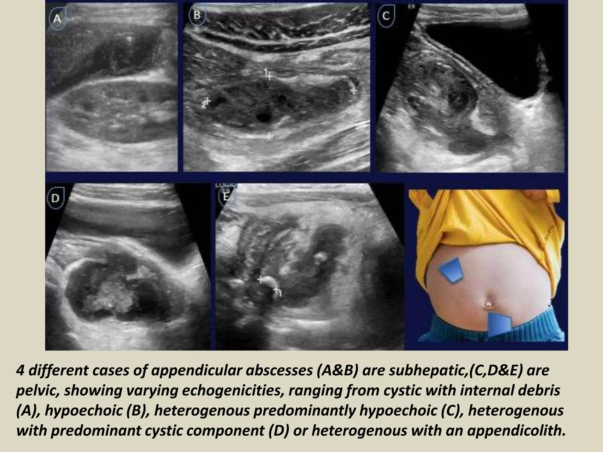 Presentation1, ultrasound of the bowel loops and the lymph nodes. | PPTX