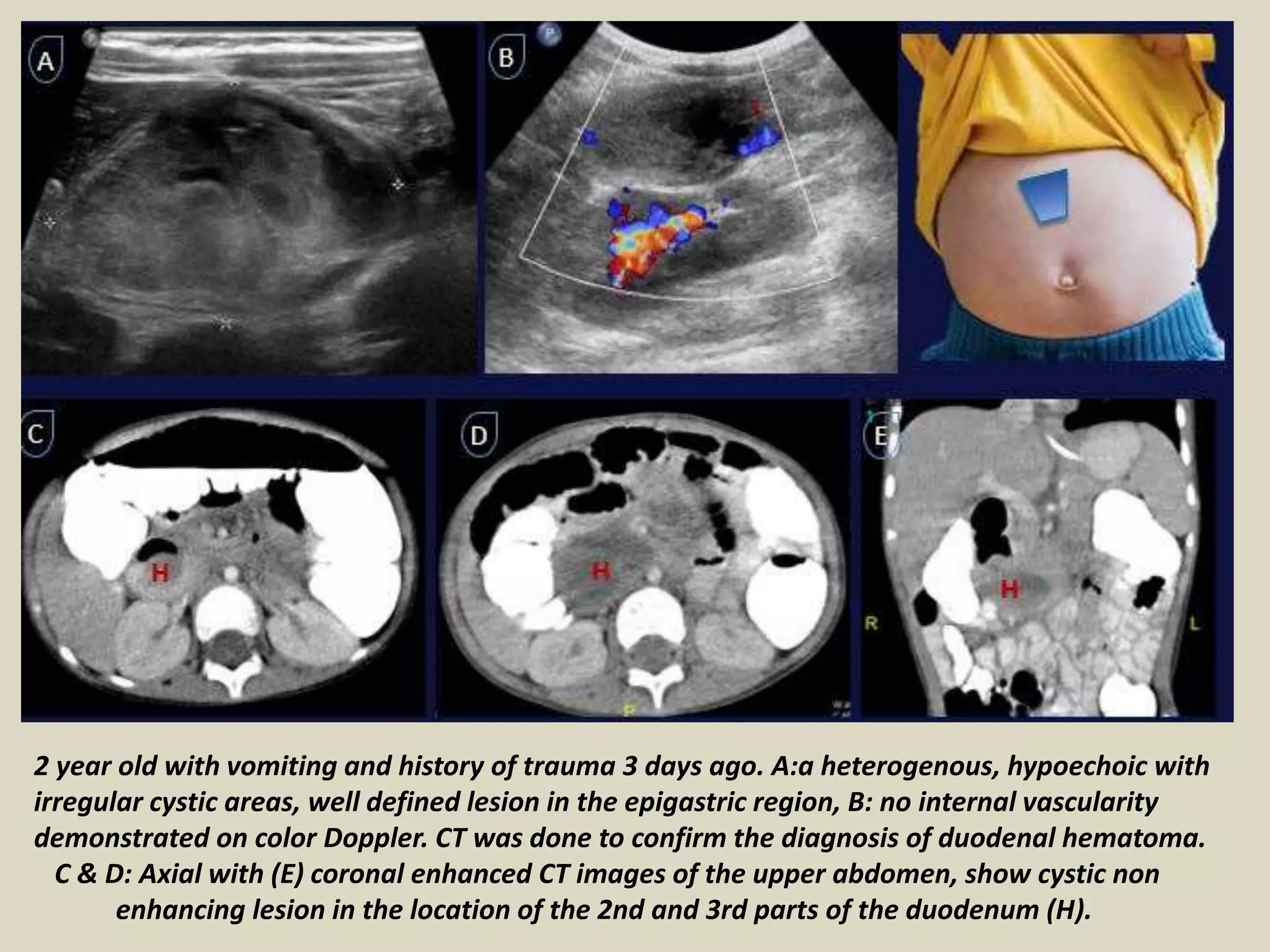 Presentation1, ultrasound of the bowel loops and the lymph nodes. | PPTX