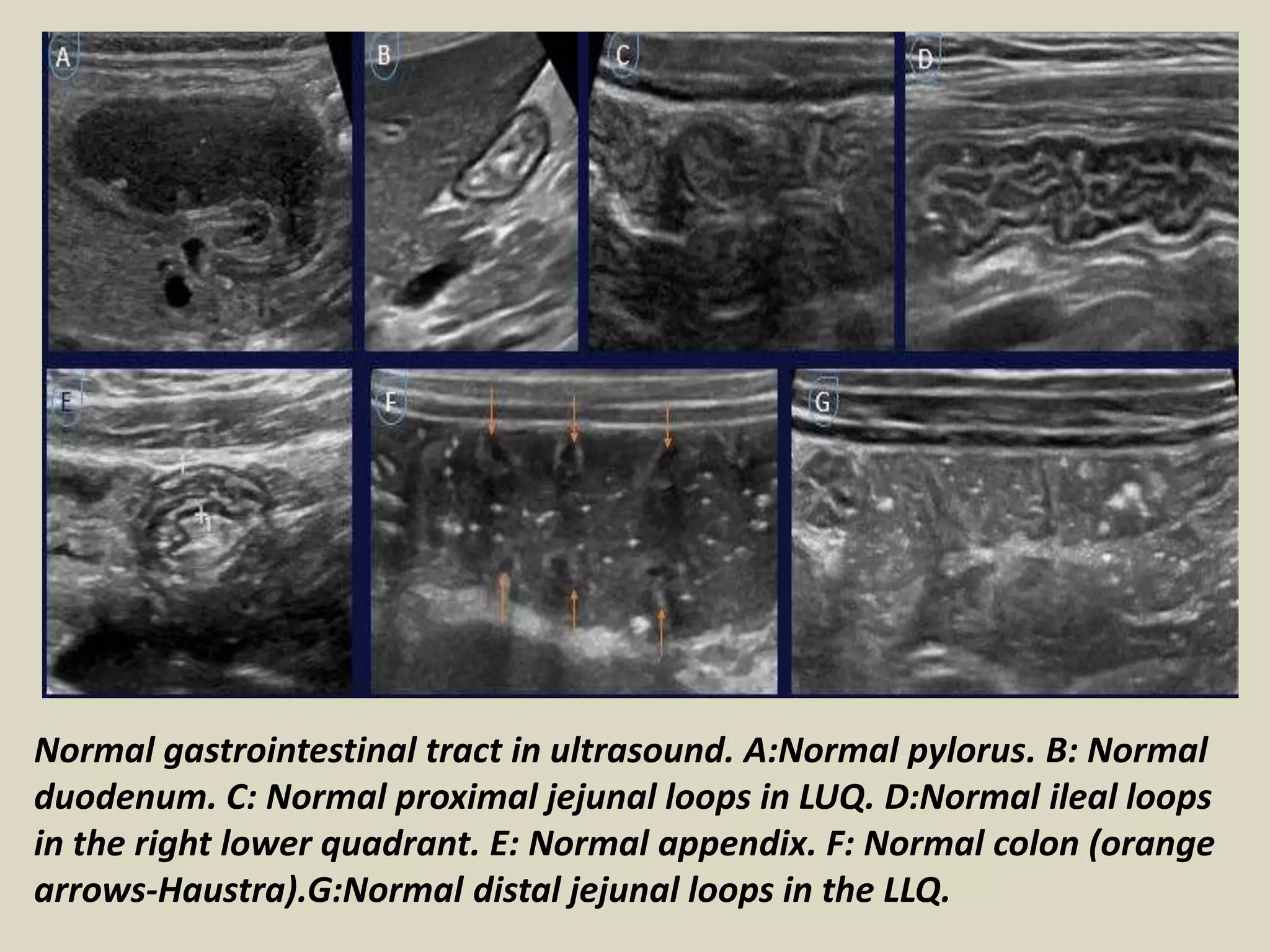 Presentation1, ultrasound of the bowel loops and the lymph nodes. | PPTX
