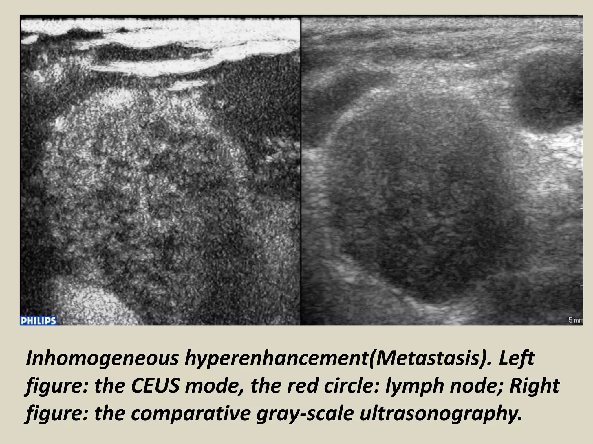 Presentation1, ultrasound of the bowel loops and the lymph nodes. | PPTX