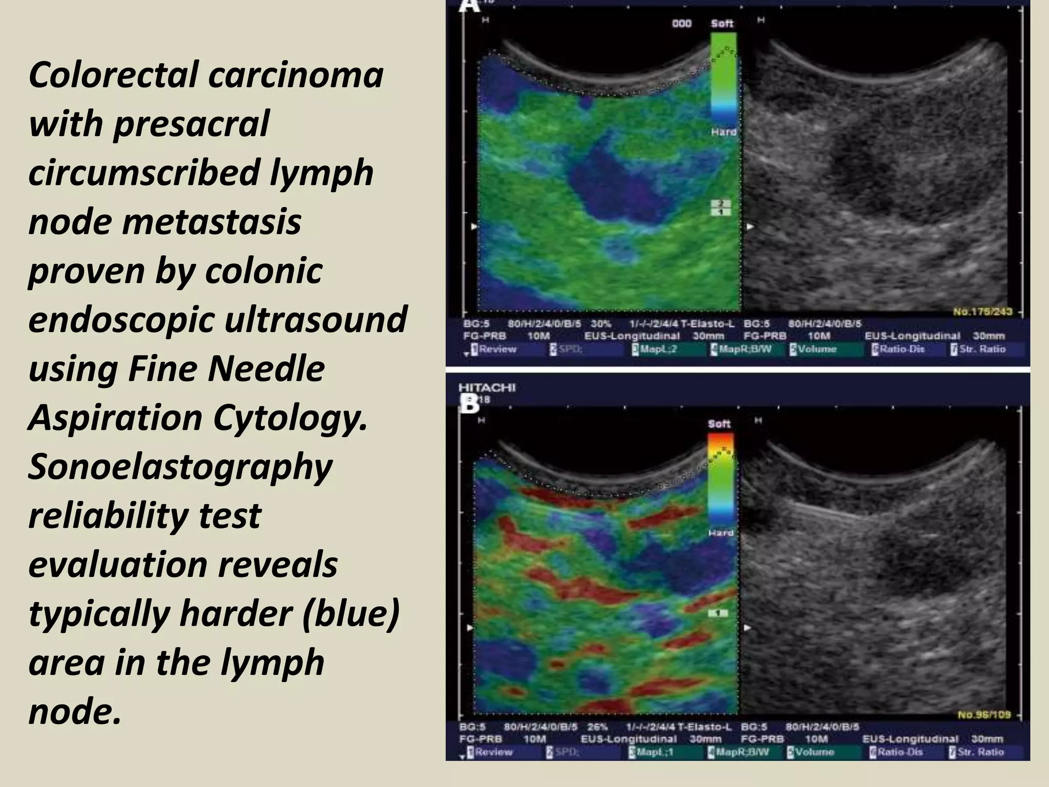 Presentation1, ultrasound of the bowel loops and the lymph nodes. | PPTX