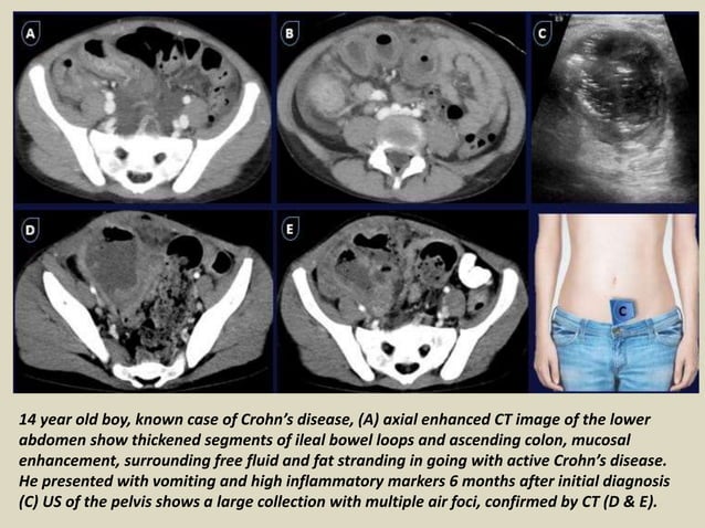 Presentation1, ultrasound of the bowel loops and the lymph nodes. | PPT