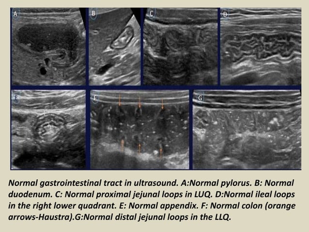 Presentation1, ultrasound of the bowel loops and the lymph nodes. | PPT