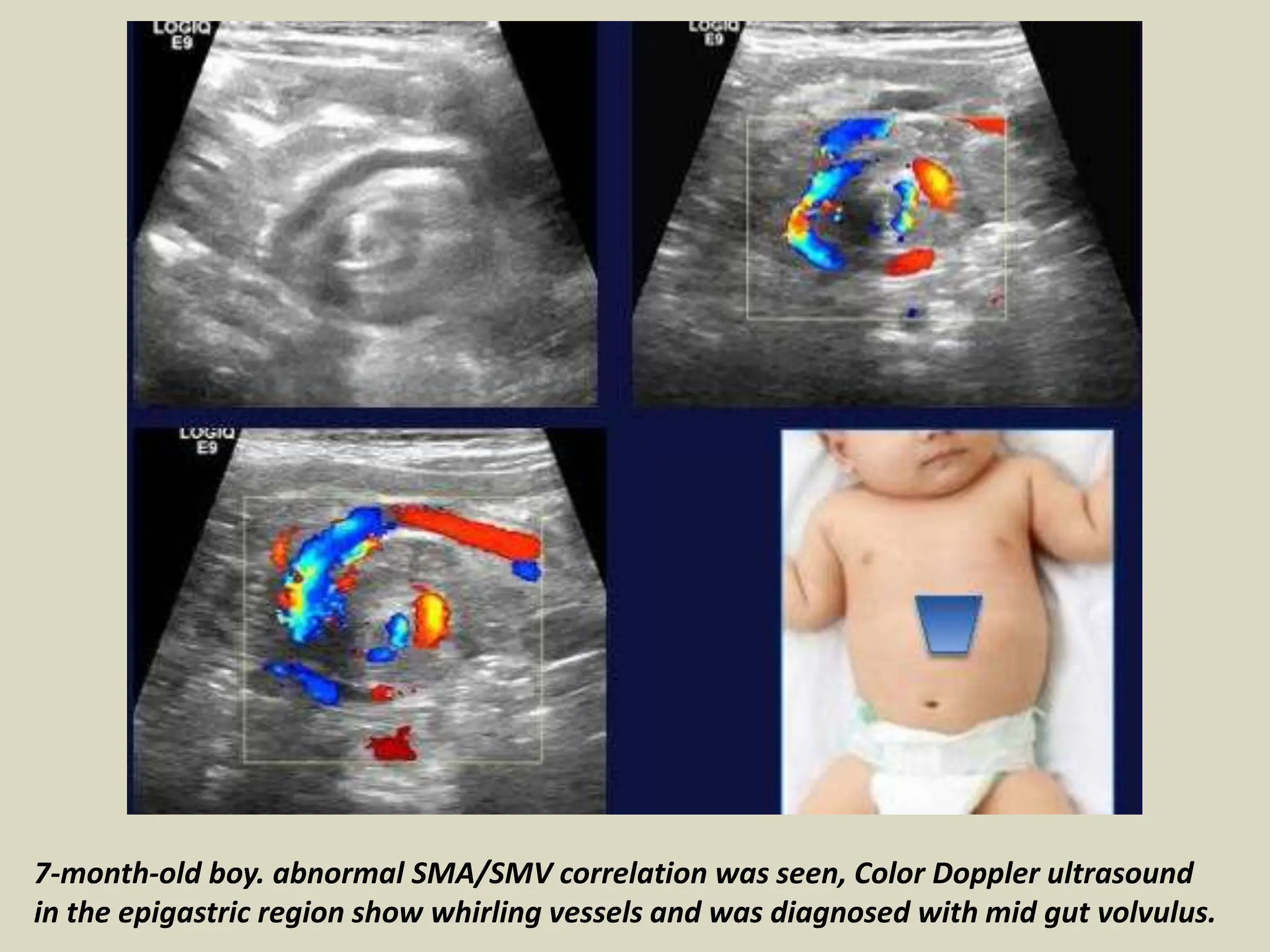 Presentation1, Ultrasound of the bowel loops and the lymph nodes..pptx
