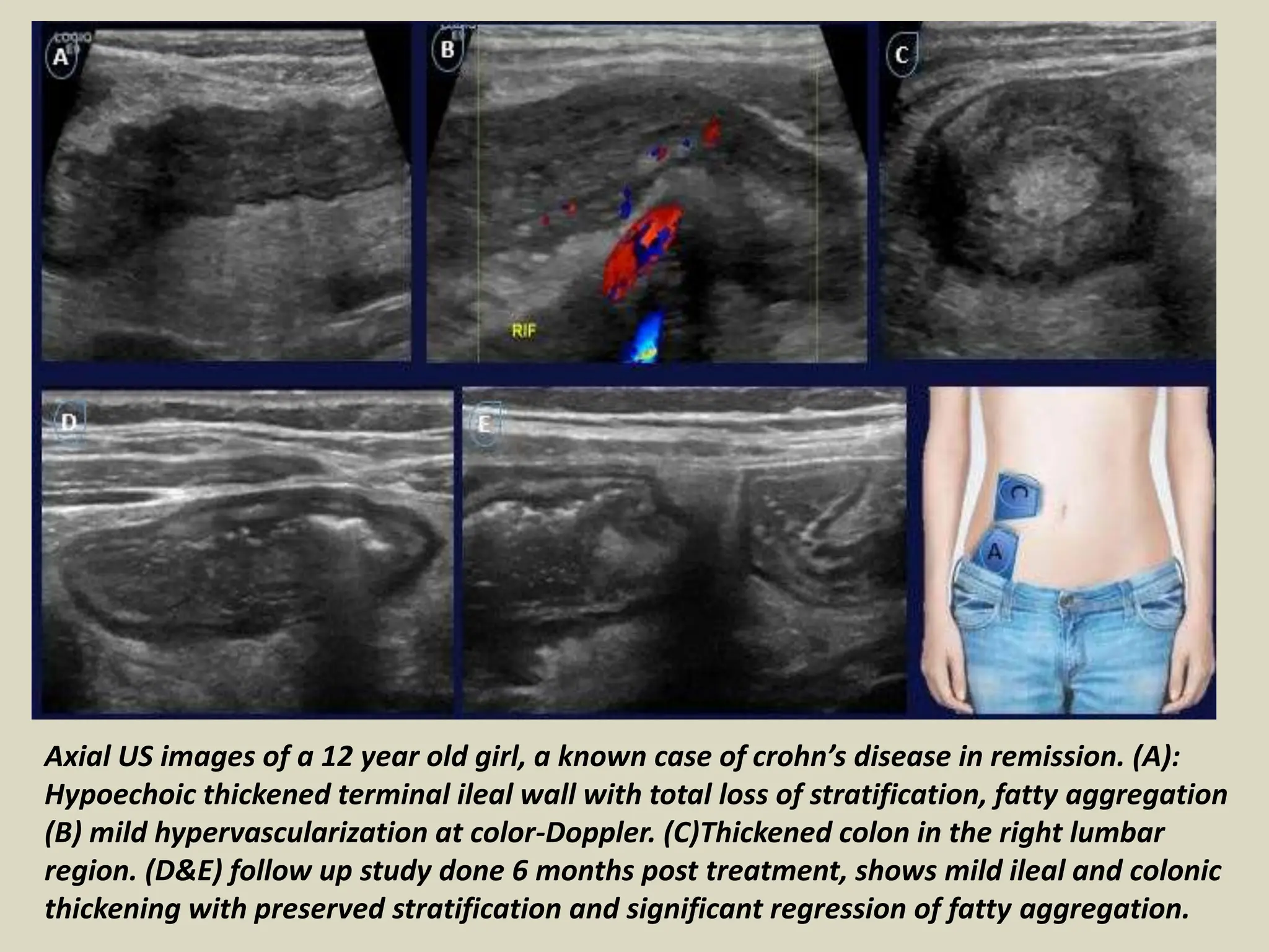Presentation1, Ultrasound of the bowel loops and the lymph nodes..pptx