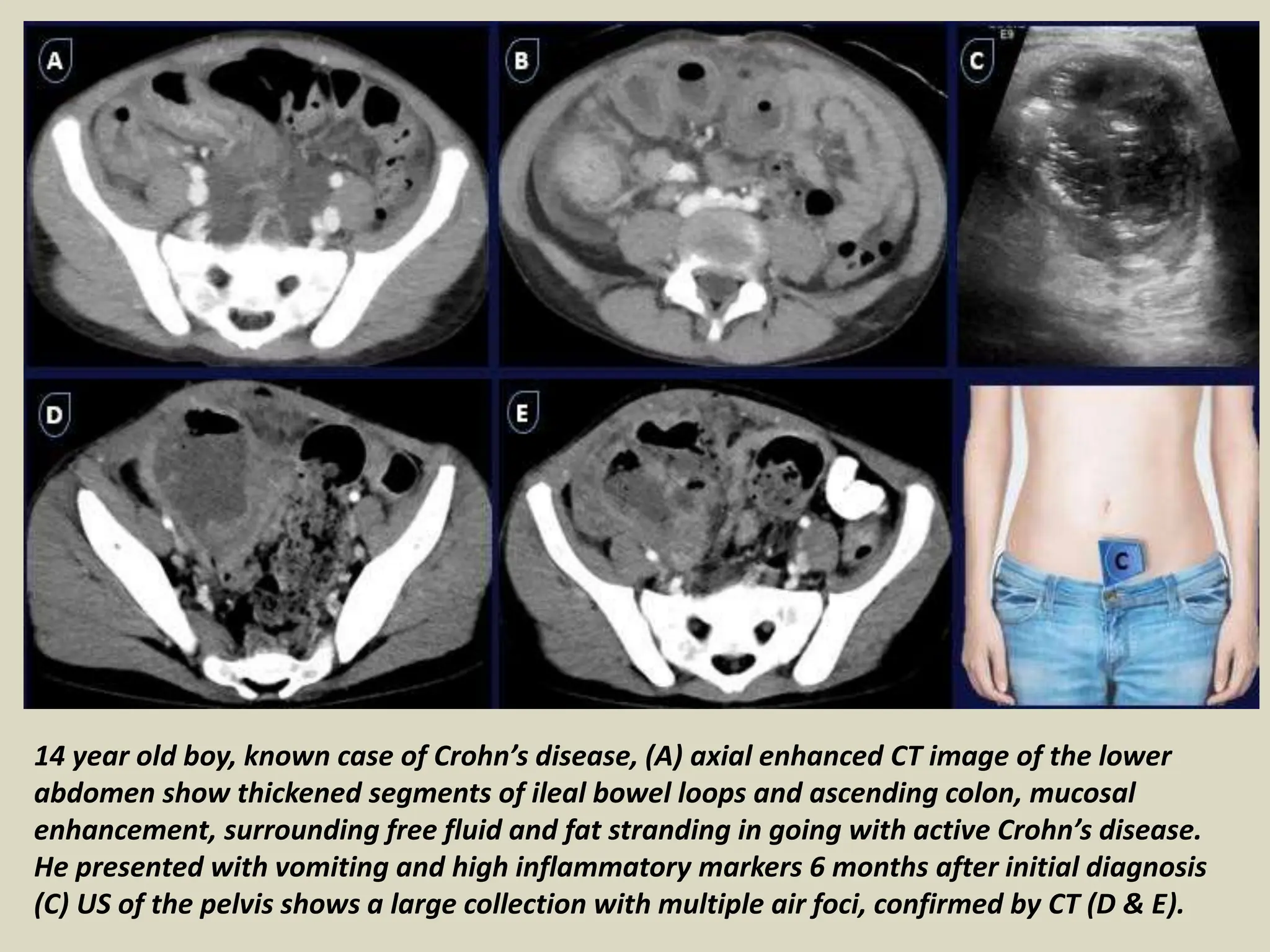 Presentation1, Ultrasound of the bowel loops and the lymph nodes..pptx