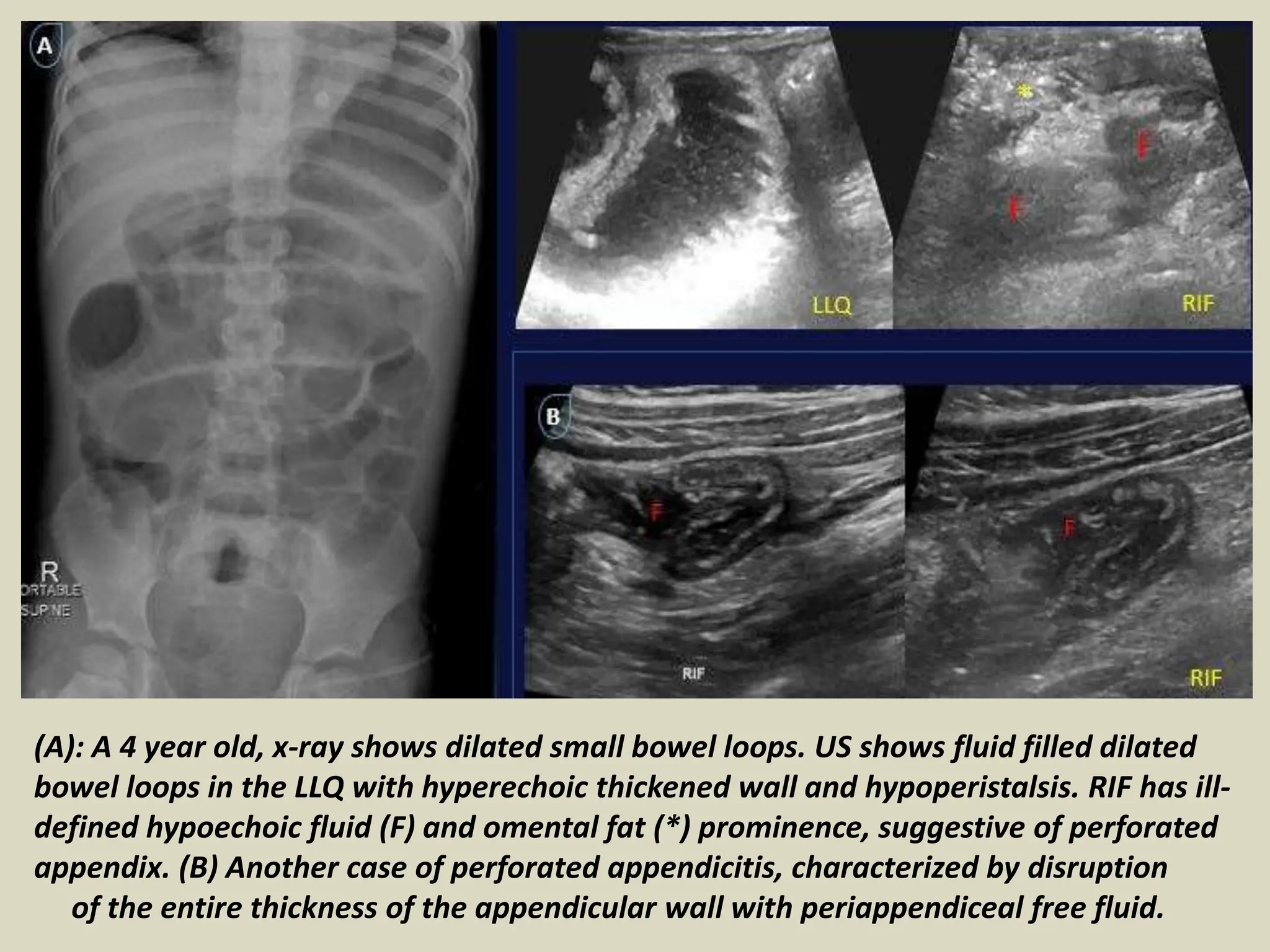 Presentation1, Ultrasound of the bowel loops and the lymph nodes..pptx