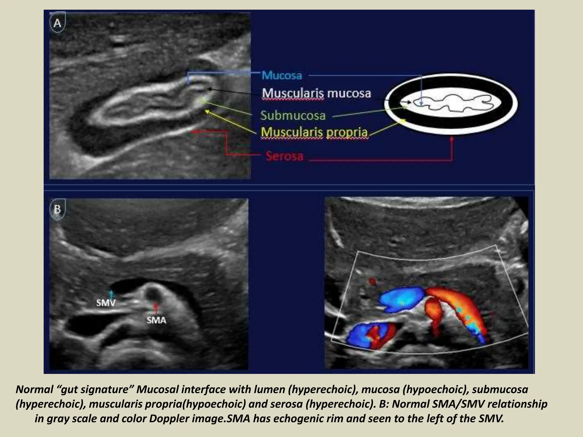 Presentation1, Ultrasound of the bowel loops and the lymph nodes..pptx