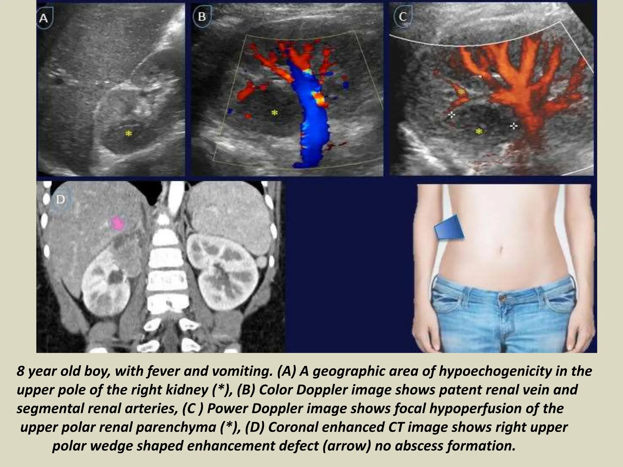 Presentation1, Ultrasound of the bowel loops and the lymph nodes..pptx