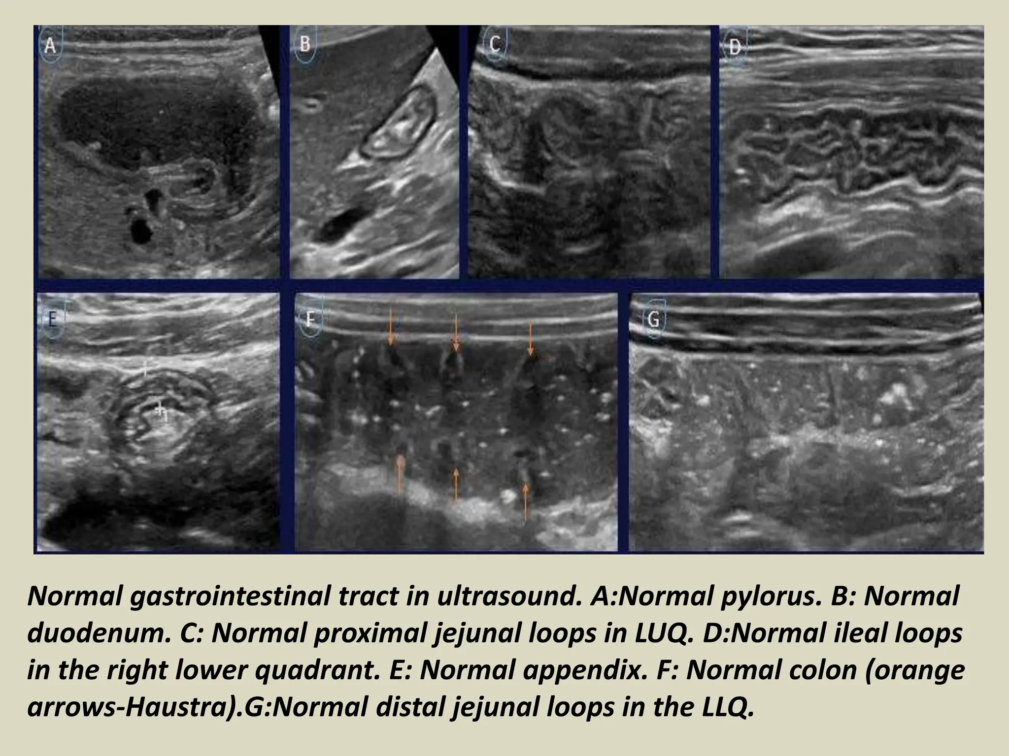 Presentation1, Ultrasound of the bowel loops and the lymph nodes..pptx