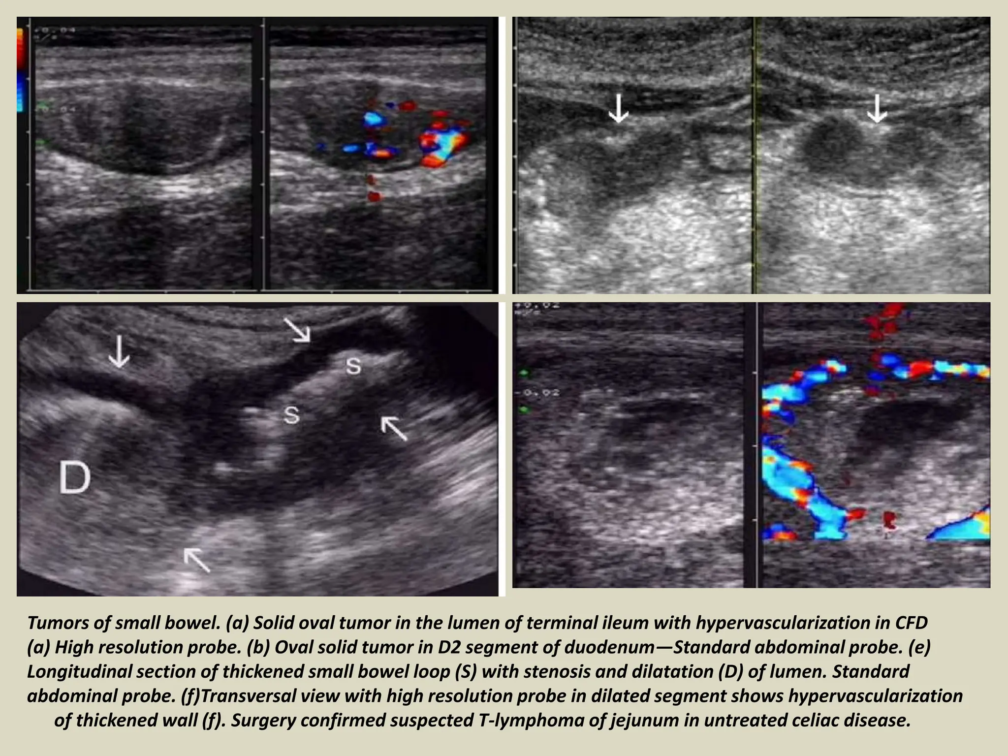 Presentation1, Ultrasound of the bowel loops and the lymph nodes..pptx
