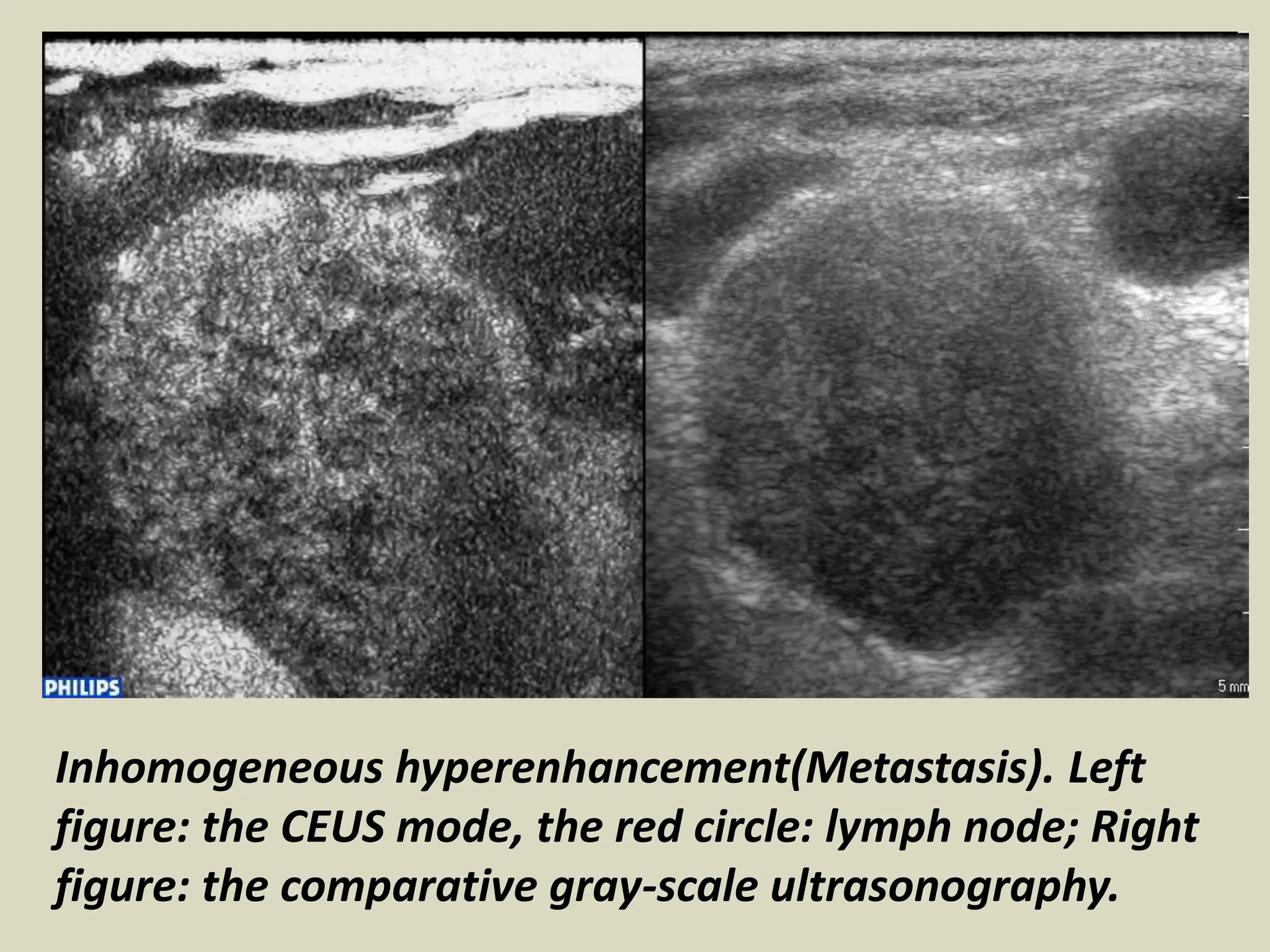 Presentation1, Ultrasound of the bowel loops and the lymph nodes..pptx