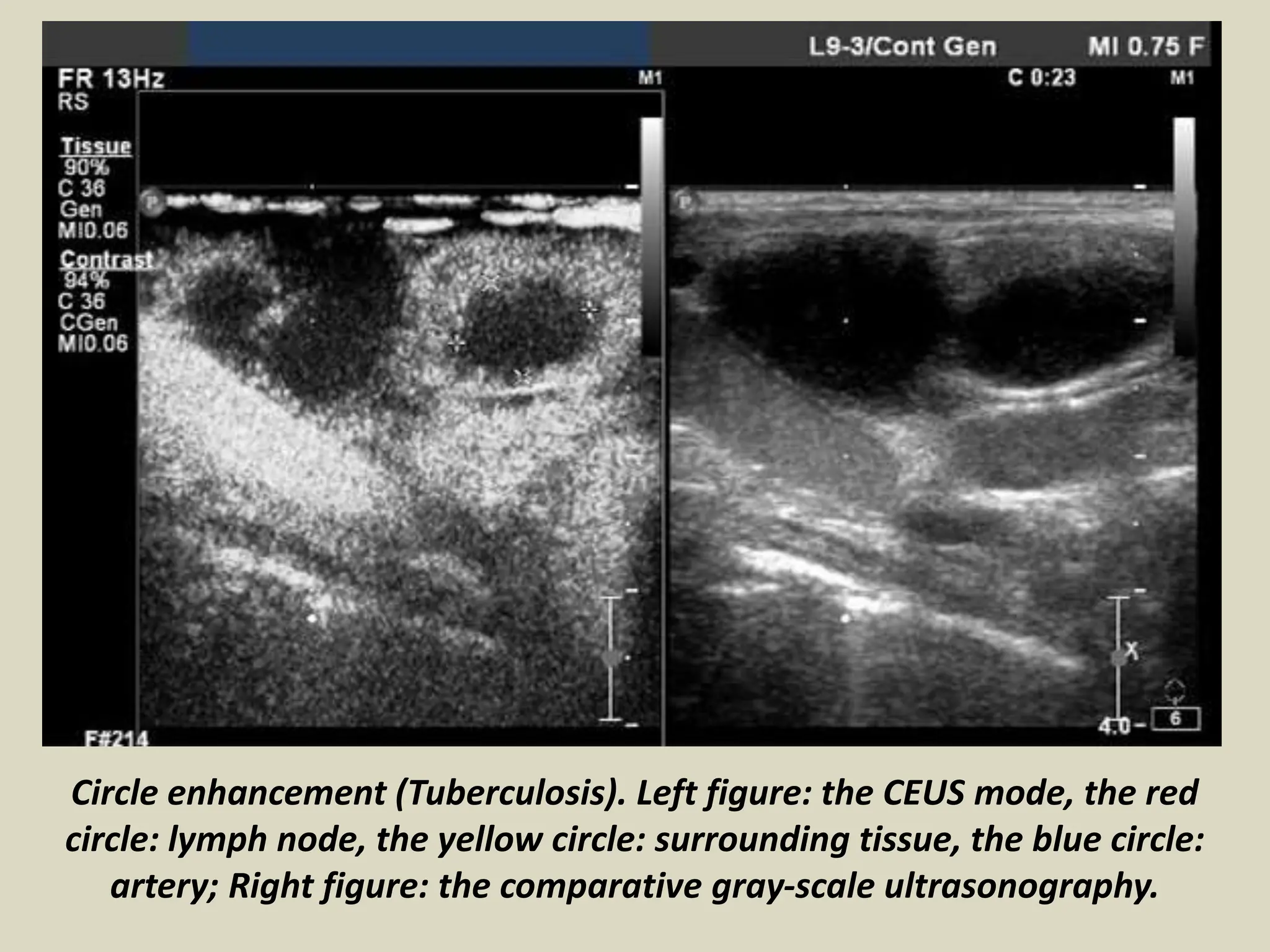 Presentation1, Ultrasound of the bowel loops and the lymph nodes..pptx