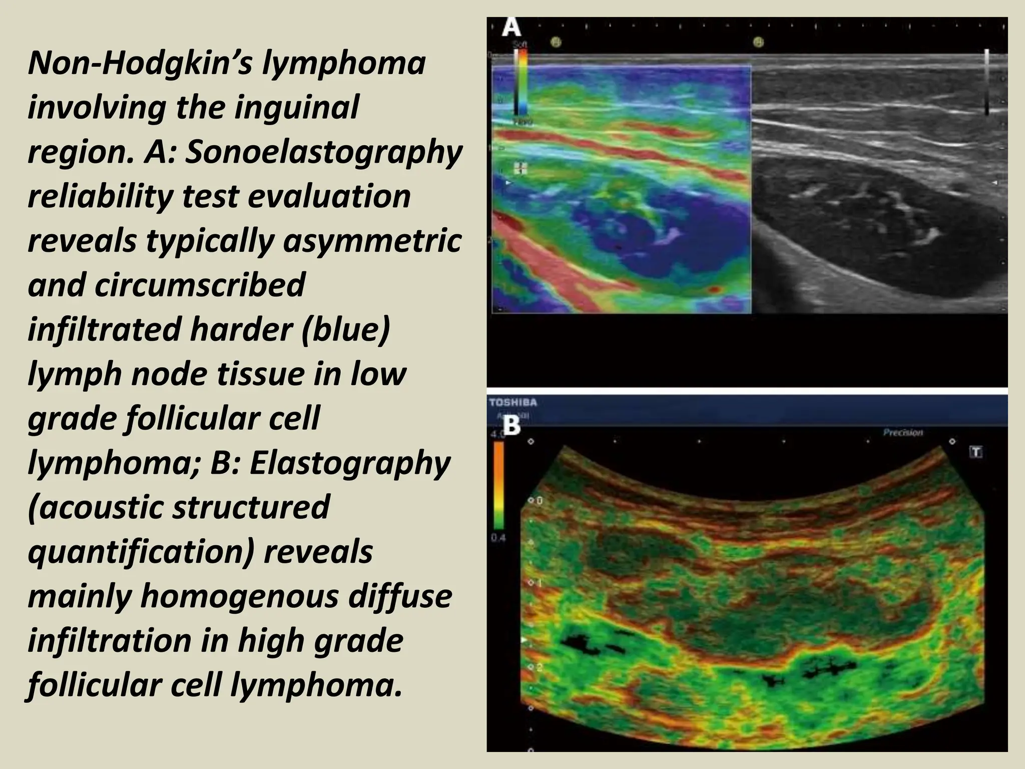 Presentation1, Ultrasound of the bowel loops and the lymph nodes..pptx