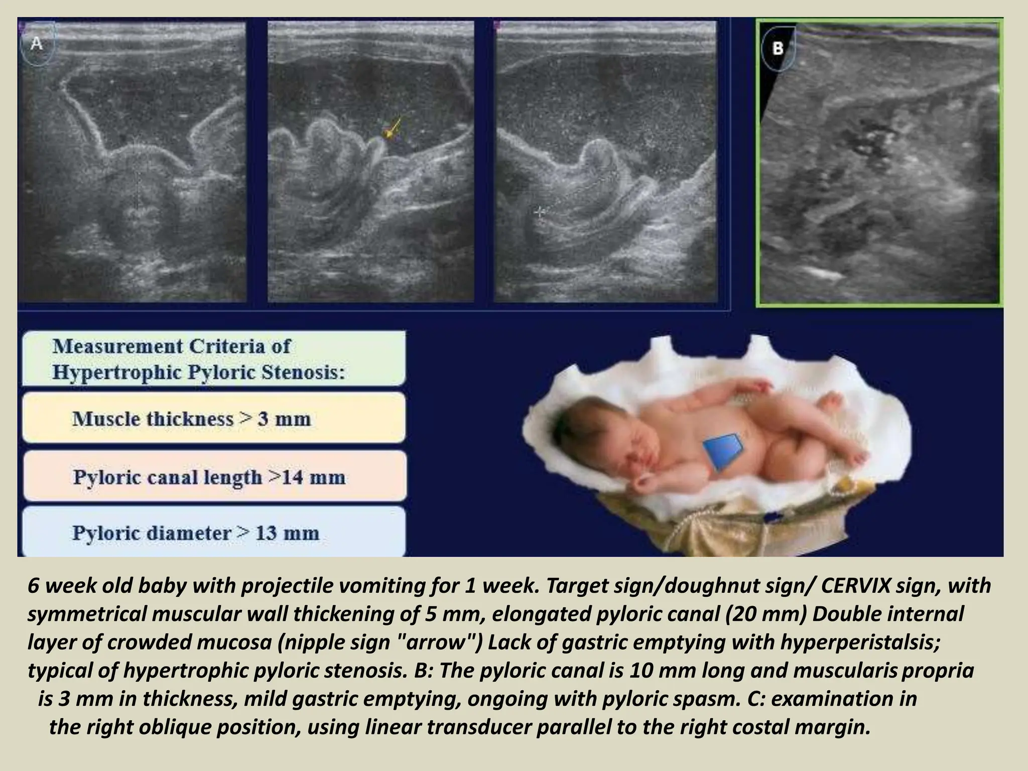 Presentation1, Ultrasound of the bowel loops and the lymph nodes..pptx