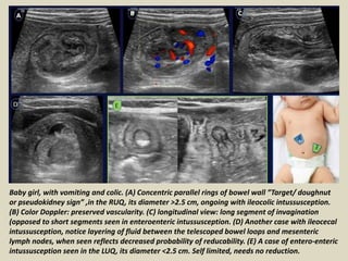Presentation1, Ultrasound of the bowel loops and the lymph nodes..pptx