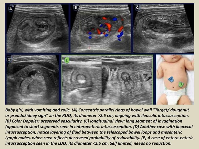 Presentation1, Ultrasound of the bowel loops and the lymph nodes..pptx