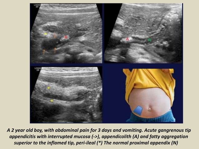 Presentation1, Ultrasound of the bowel loops and the lymph nodes..pptx