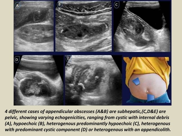 Presentation1, Ultrasound of the bowel loops and the lymph nodes..pptx
