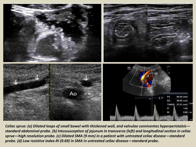 Presentation1, Ultrasound of the bowel loops and the lymph nodes..pptx