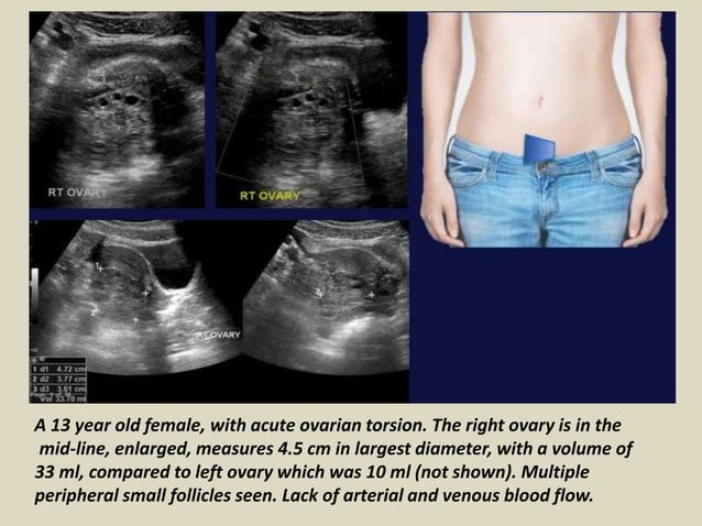 Presentation1, Ultrasound of the bowel loops and the lymph nodes..pptx