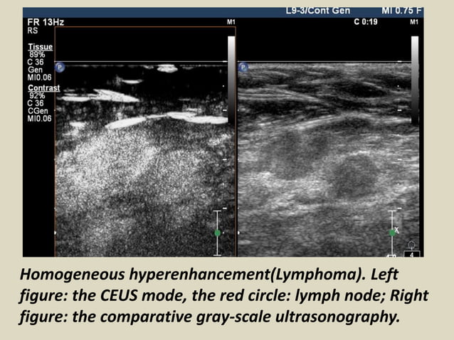 Presentation1, Ultrasound of the bowel loops and the lymph nodes..pptx