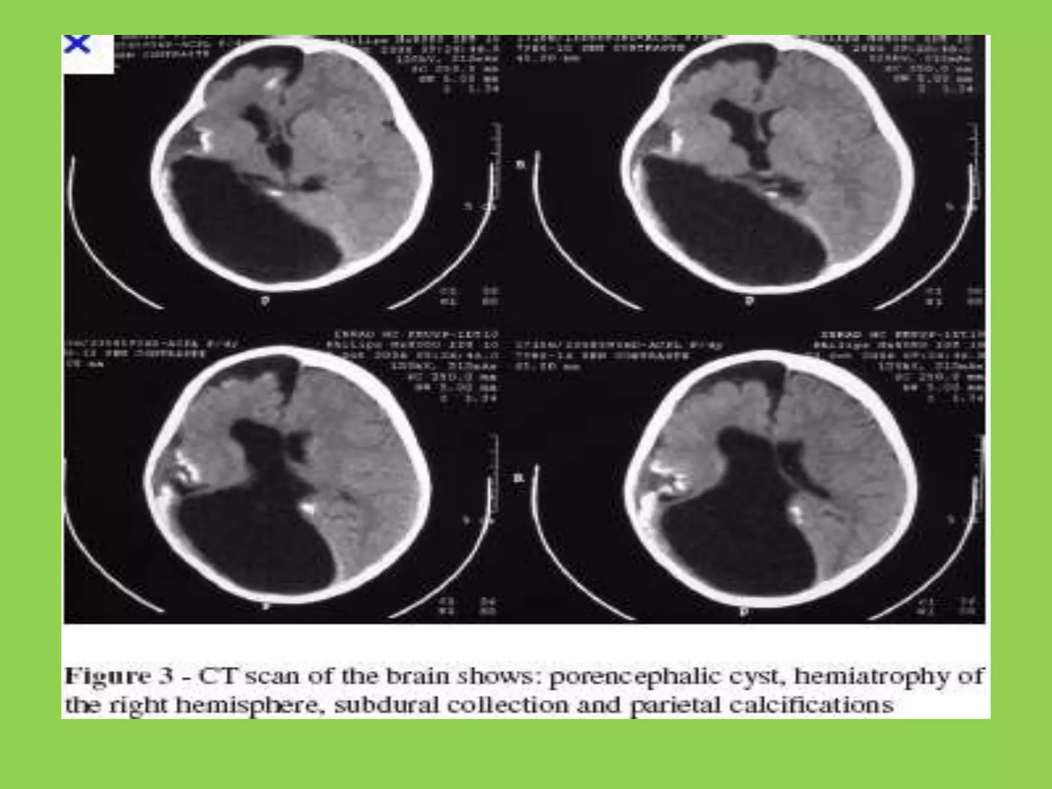 Presentation2.pptx intra cranial cyst | PPTX