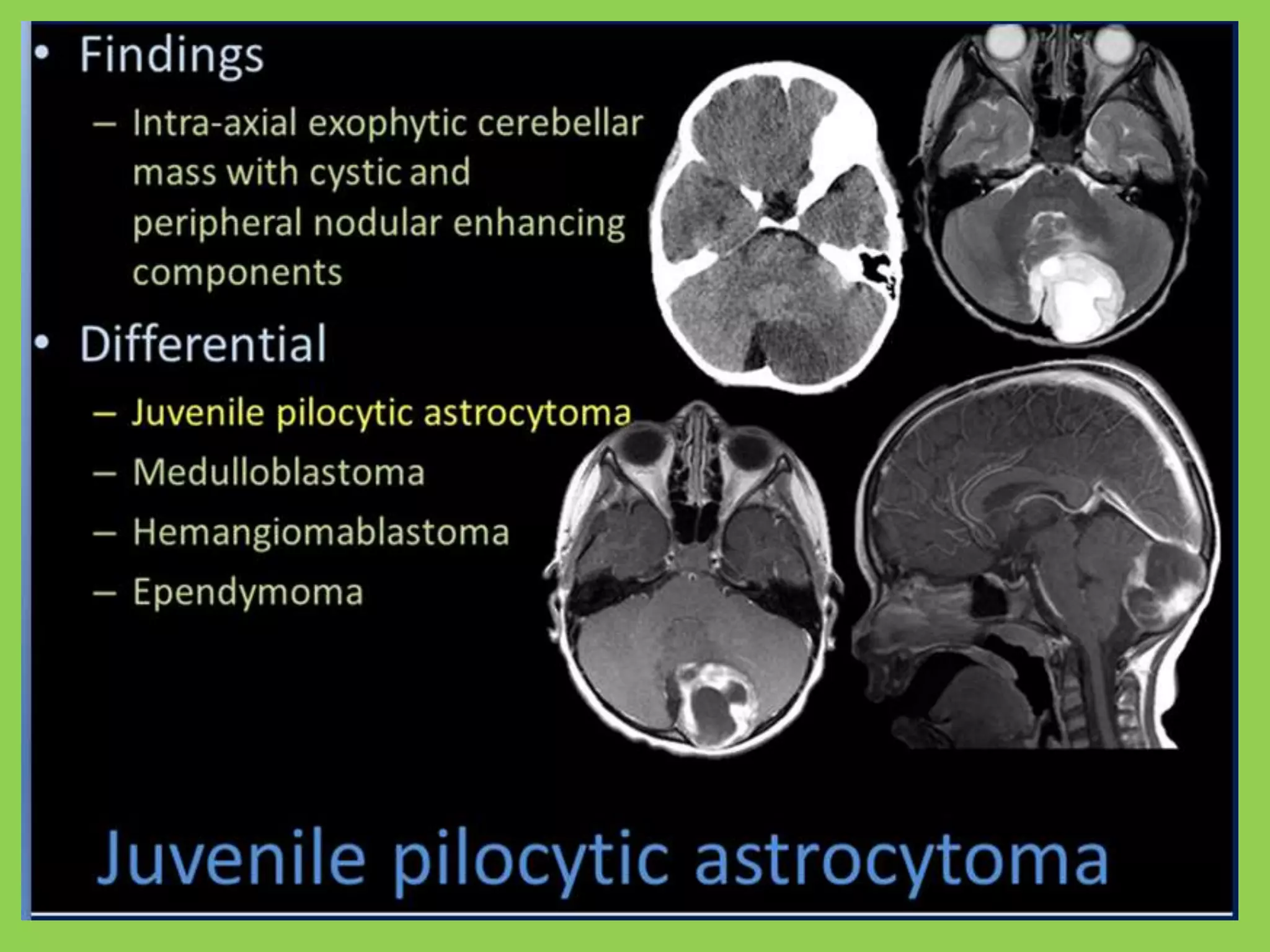 Presentation2.pptx intra cranial cyst | PPTX