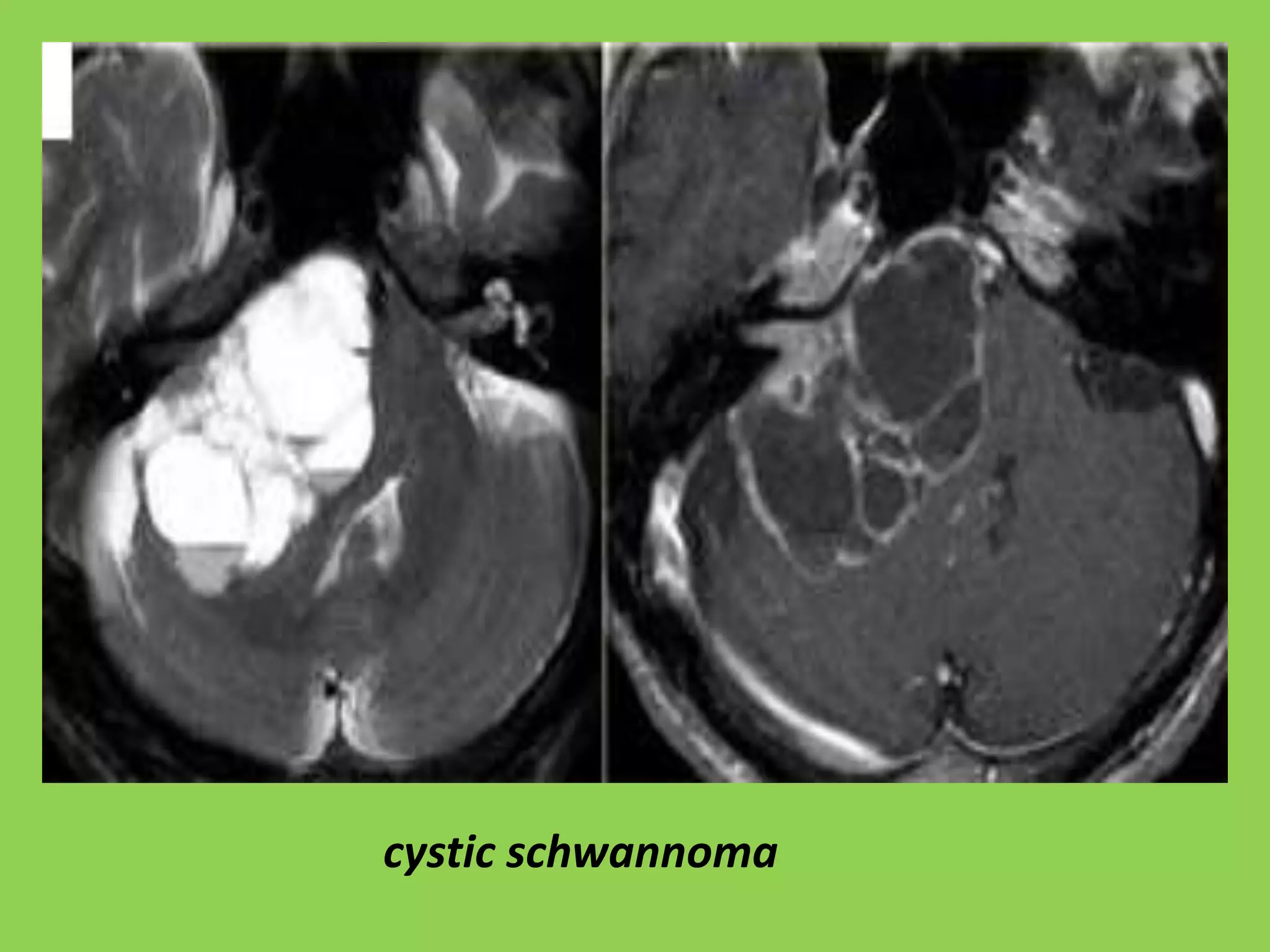 Presentation2.pptx intra cranial cyst | PPTX